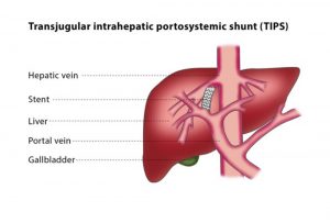 TIPS Recanalization Success Story by Clint - Portal Hypertension ...